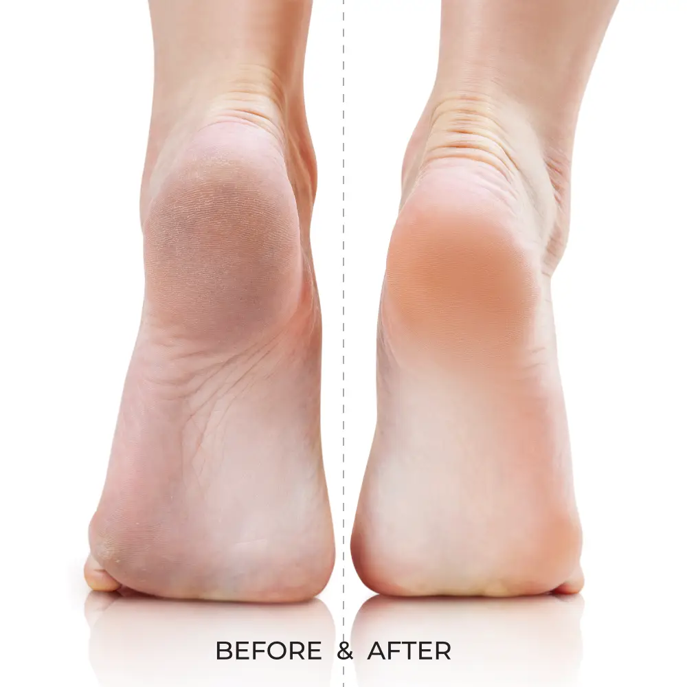 Kiss New York - Dual-Sided Foot File for Callus Removal and Smooth ...